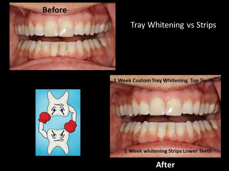 Tray vs Strips | Delmarva Dental Services