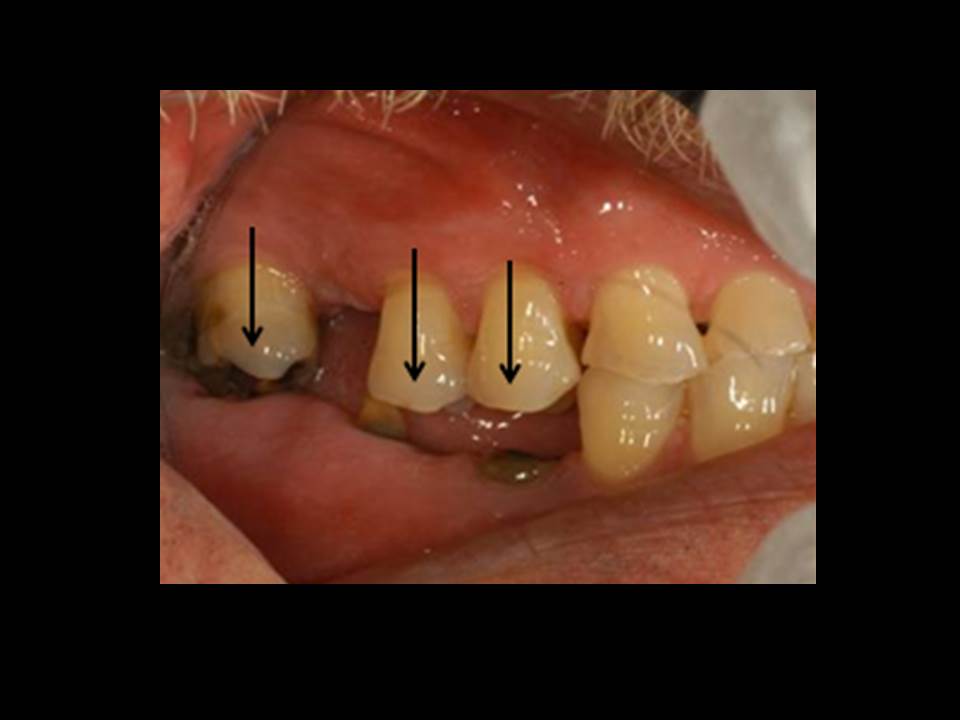 Adverse Effects Of Not Replacing Missing Teeth Where